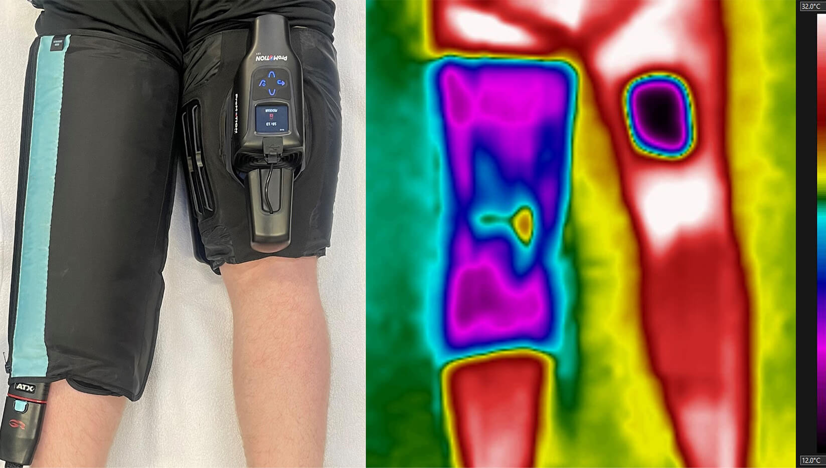 the keyhole approach to cryotherapy - ProMOTION