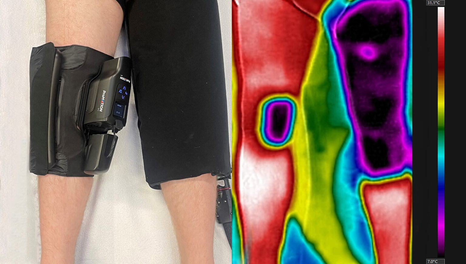 the keyhole approach to cryotherapy - ProMOTION